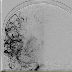 REPERFUSION SCALE,TICI,STROKE,ENDOVASCULAR | hubstroke.com