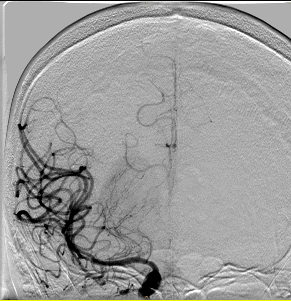 (English) REPERFUSION SCALE,TICI,STROKE,ENDOVASCULAR | hubstroke.com