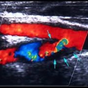 ULTRASOUND STROKE - hubstroke.com