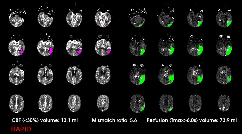 (English) RAPID thrombectomy in CT perfusion | hubstroke.com